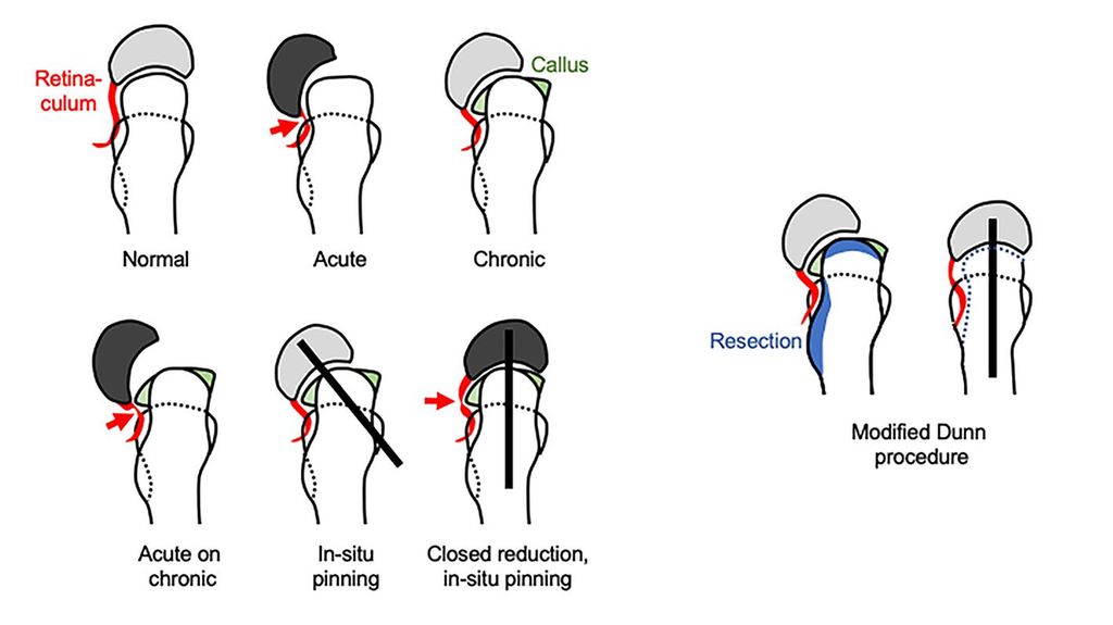 Epiphysiolysis capitis femoris: Notfallversorgung - Orthopädie ...