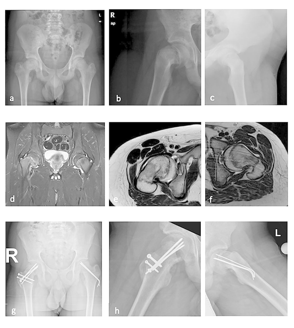 Epiphysiolysis capitis femoris: Notfallversorgung - Orthopädie ...