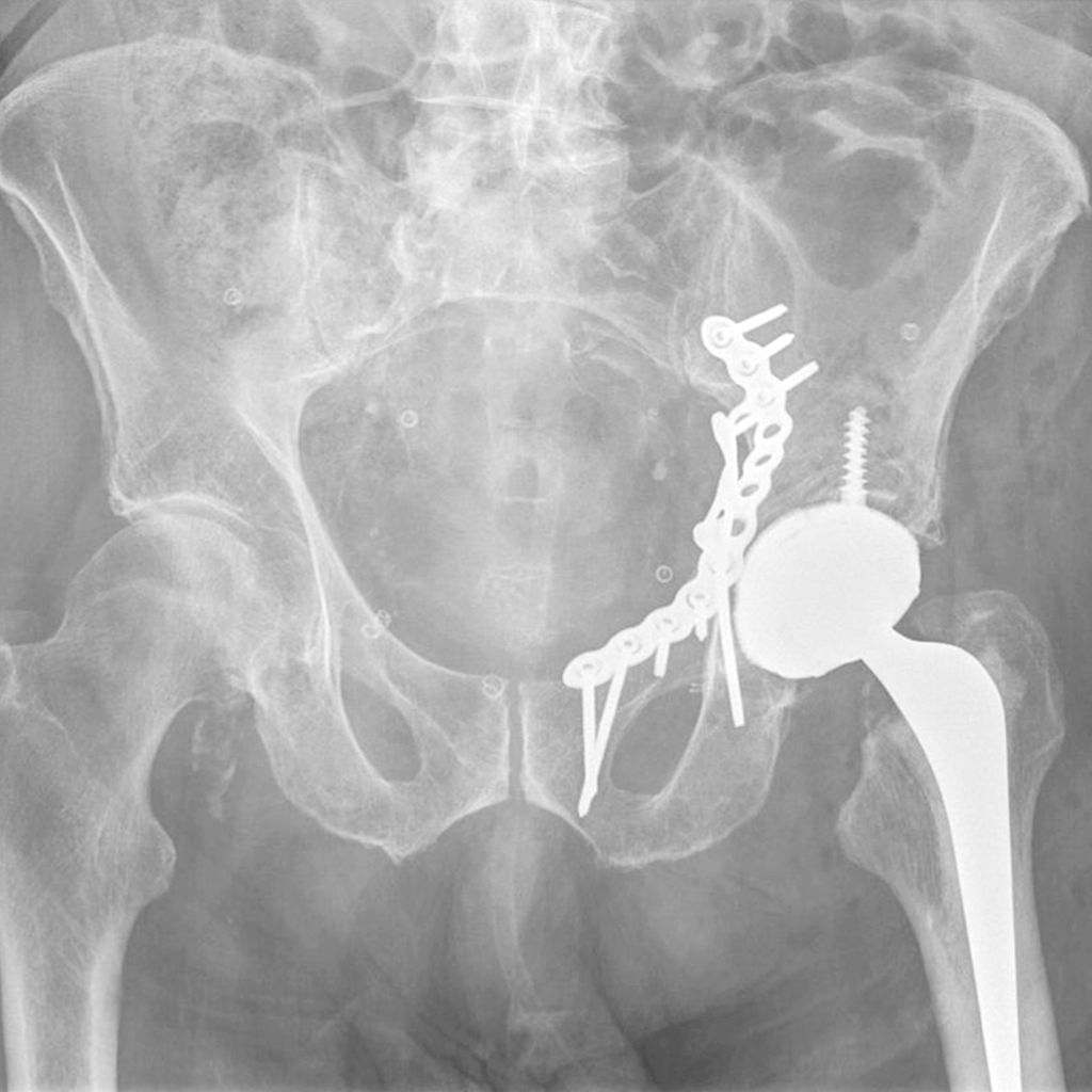 Fragilitätsfrakturen von Beckenring und Acetabulum - Orthopädie ...