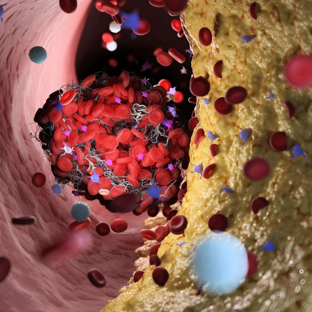 ISTH 2024: Thrombolyse, Risikoprädiktion, Hämophilieprophylaxe ...