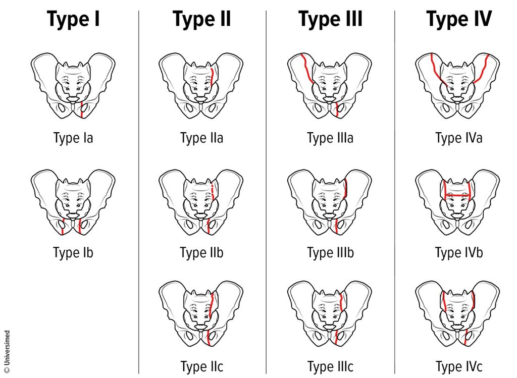 Fragilitätsfrakturen von Beckenring und Acetabulum - Orthopädie ...