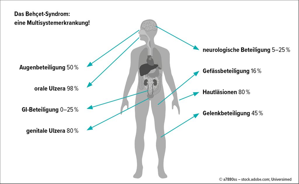 Behçet-Syndrom: von der oft schwierigen Diagnose zur Therapie ...