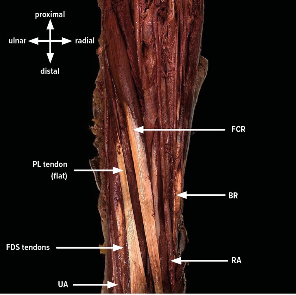 Variations in forearm tendons – A clinical-anatomical guide ...