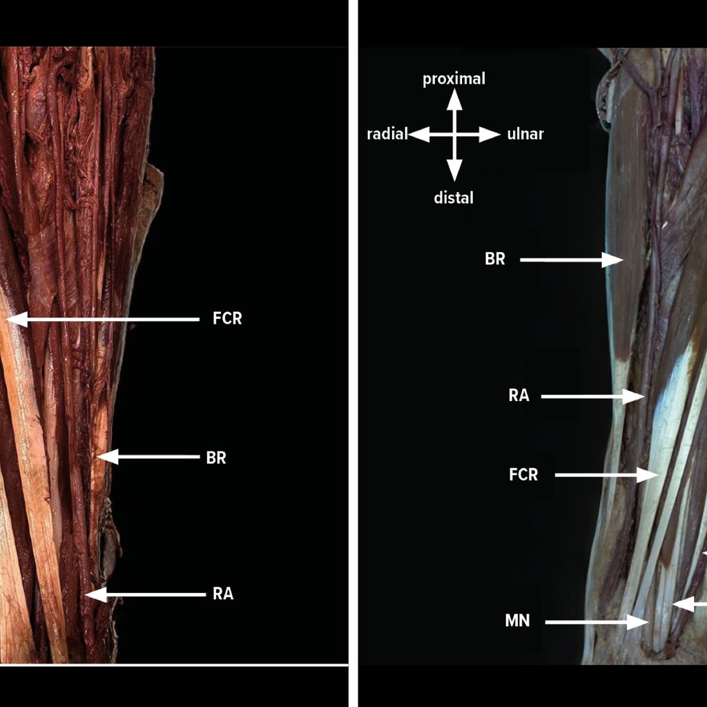 Variations in forearm tendons – A clinical-anatomical guide ...