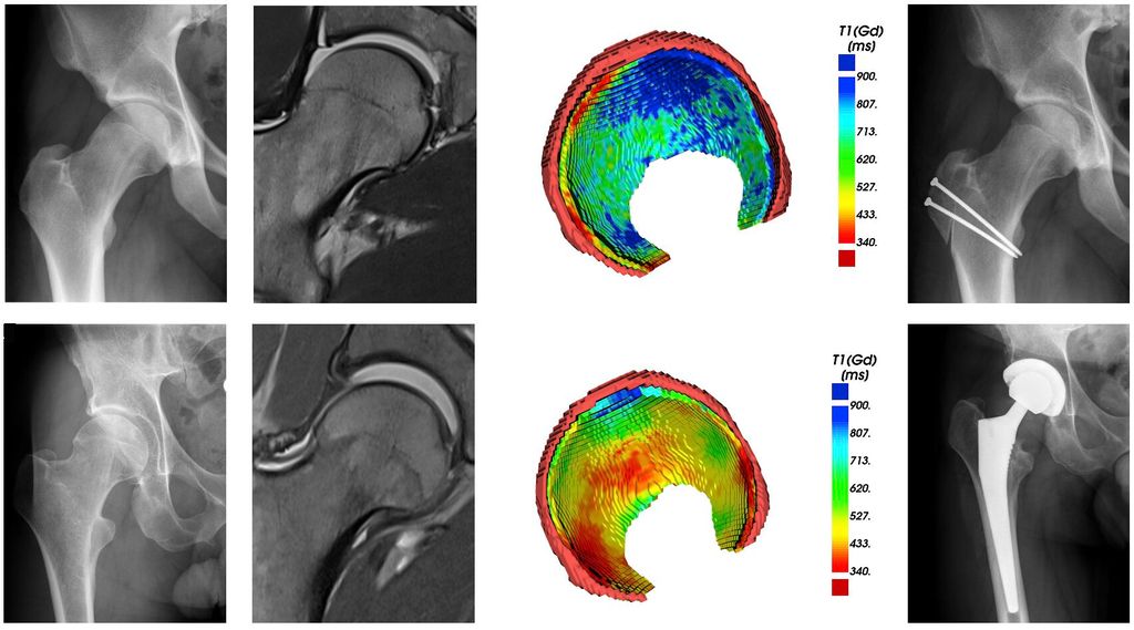 Advanced MRI techniques in hip cartilage assessment - Orthopädie ...