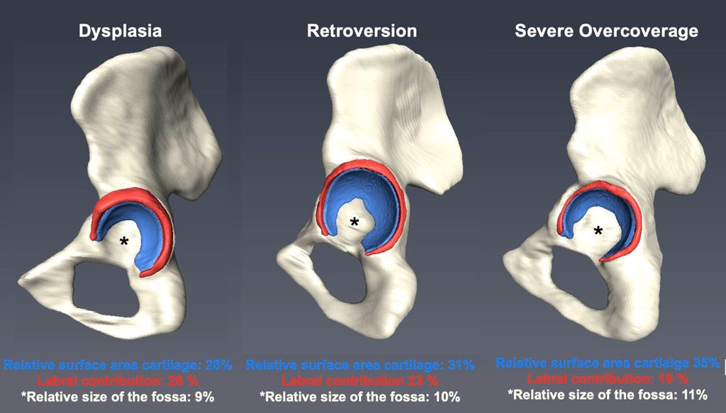 Advanced MRI techniques in hip cartilage assessment - Orthopädie ...