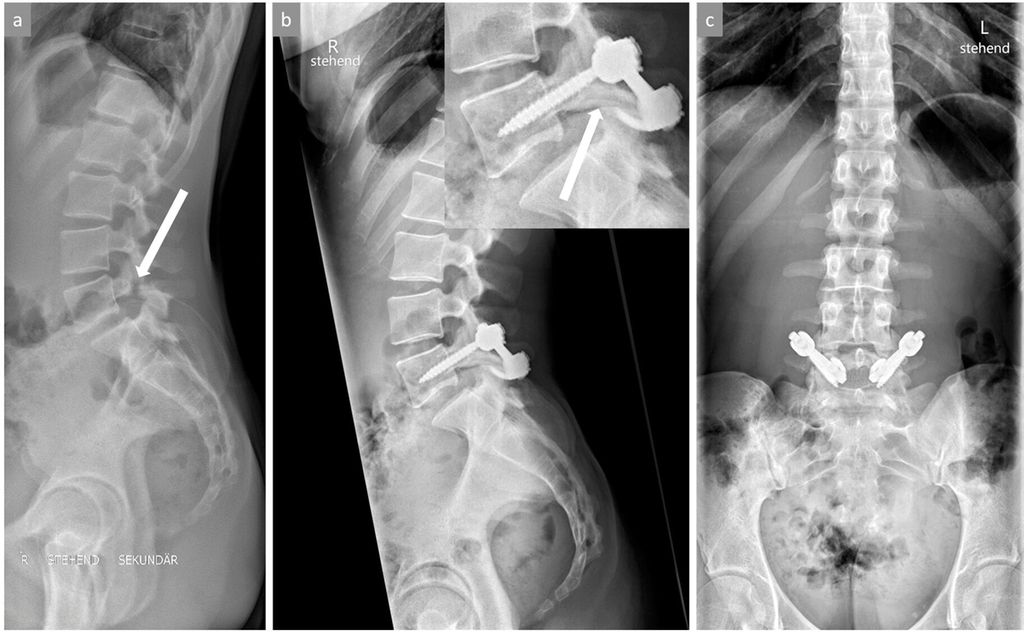 Isthmische Spondylolyse und Spondylo-listhese beKindern und ...