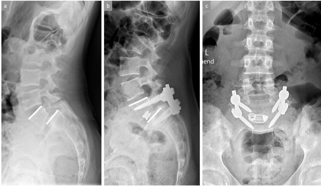 Isthmische Spondylolyse und Spondylo-listhese beKindern und ...