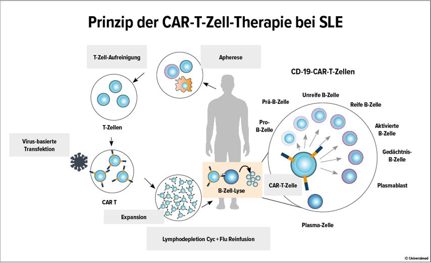 CAR-T-Zell-Therapie beim systemischen Lupus – ein neuer Meilenstein ...