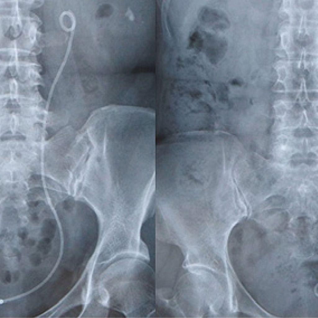 Harnleiterschienung: Indikation, Management und Nachsorge bei Urolithi ...