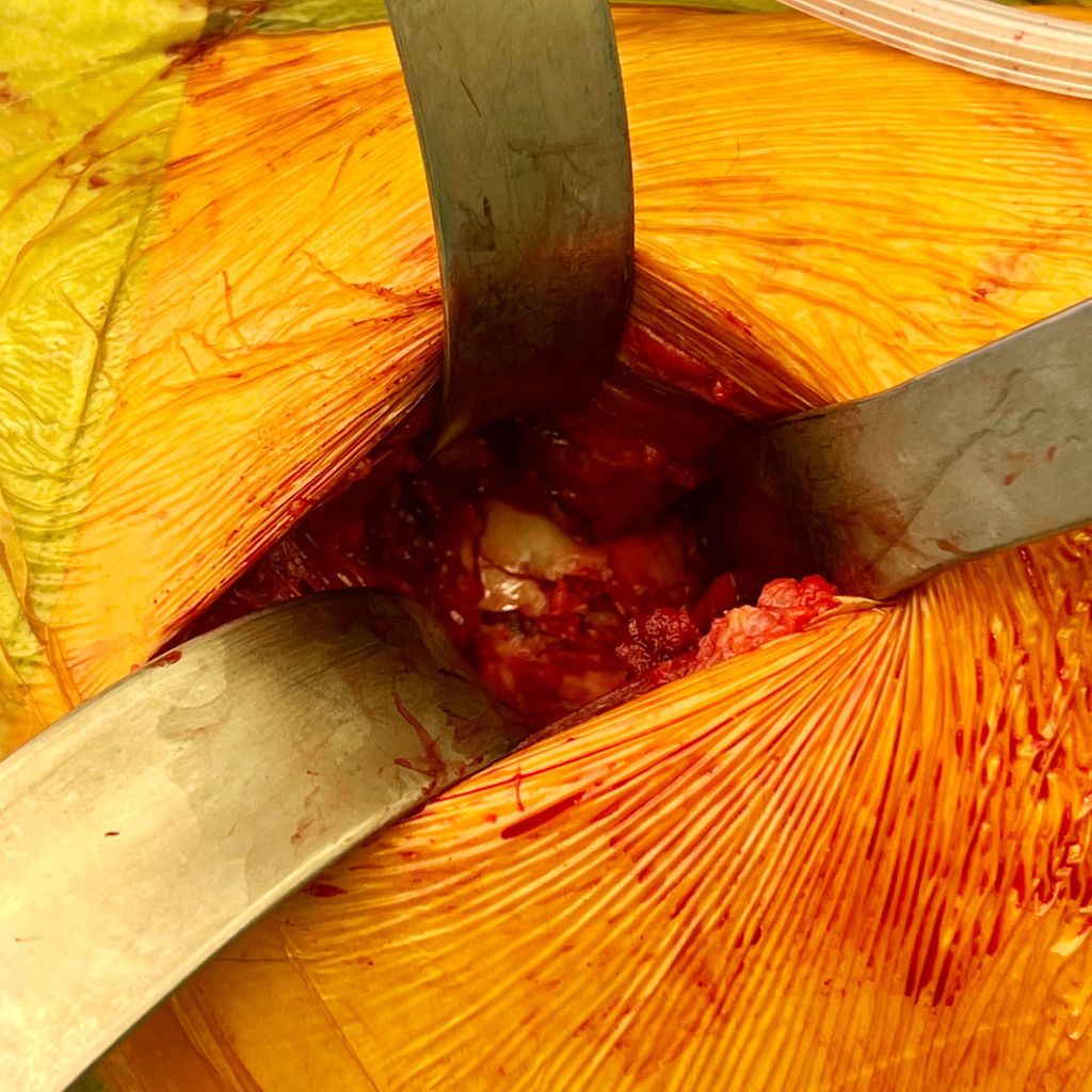 Osteosynthese über den minimalinvasiven direkt anterioren Hüftzugang ...