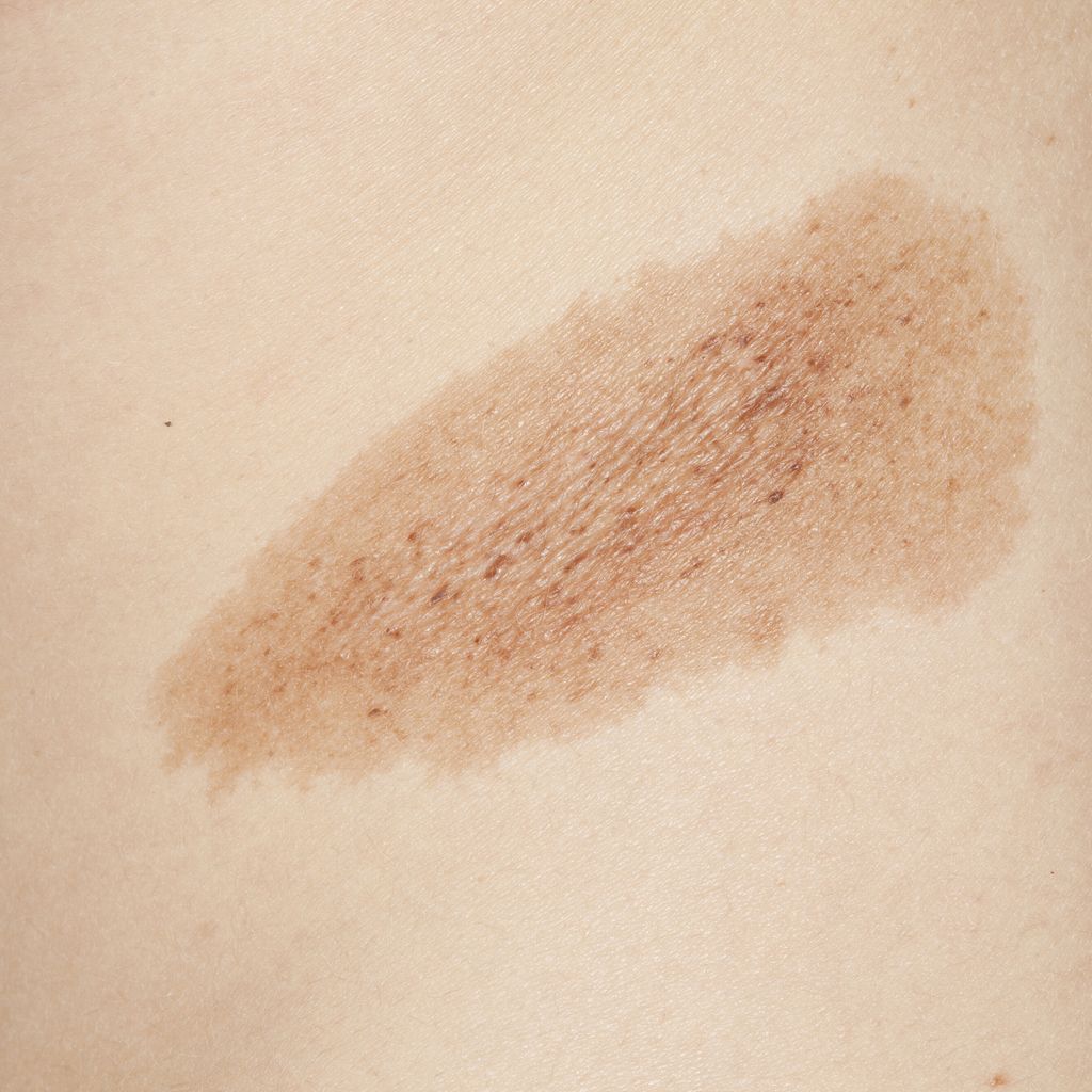 Stellenwert kutaner Leitsymptome im Zeitalter der Molekulargenetik ...