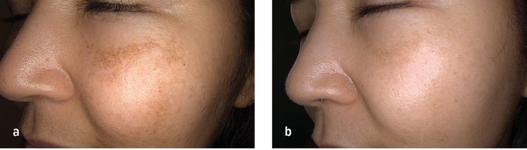 Versatile use of picosecond lasers - Plastische Chirurgie - Universimed ...