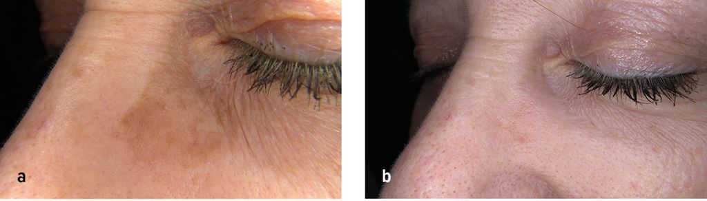Versatile use of picosecond lasers - Plastische Chirurgie - Universimed ...