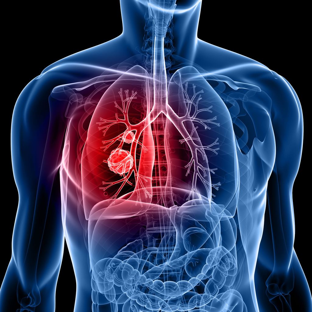 Investigation des nodules pulmonaires - Médecine interne - Universimed ...
