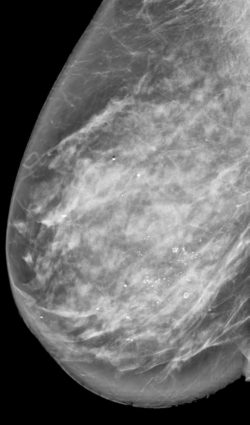 Muss das duktale Carcinoma in situ noch operativ behandelt werden ...