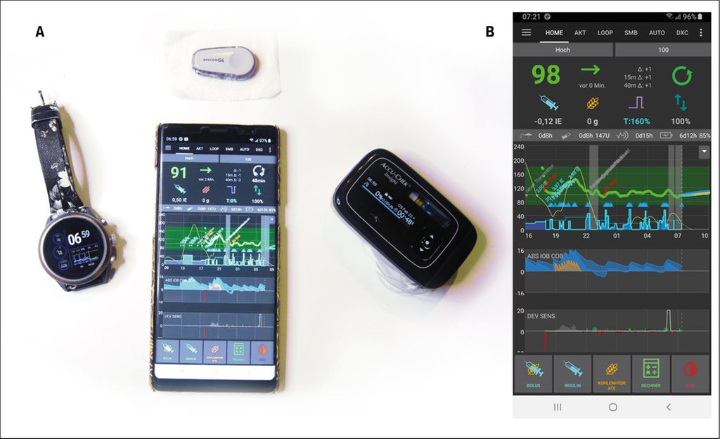 „Hybrid Closed-Loop“-Systeme – aktuelle Entwicklungen - Diabetologie ...