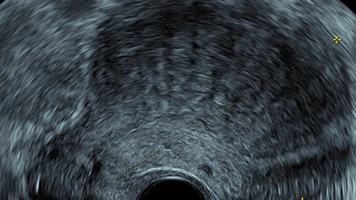 Differenzierte gynäkologische Sonografie: Adenomyose - Gynäkologie ...