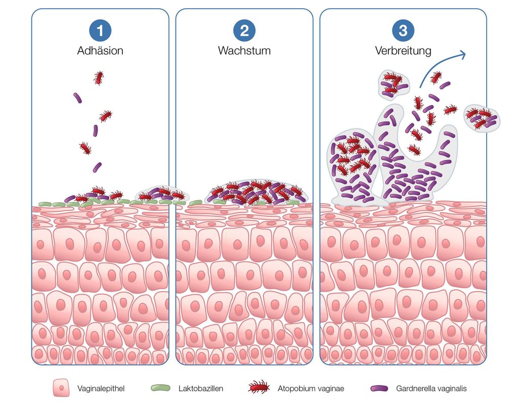 Fluomizin® zeigt Wirksamkeit gegen Biofilm bei bakteriellen Vaginalinf ...