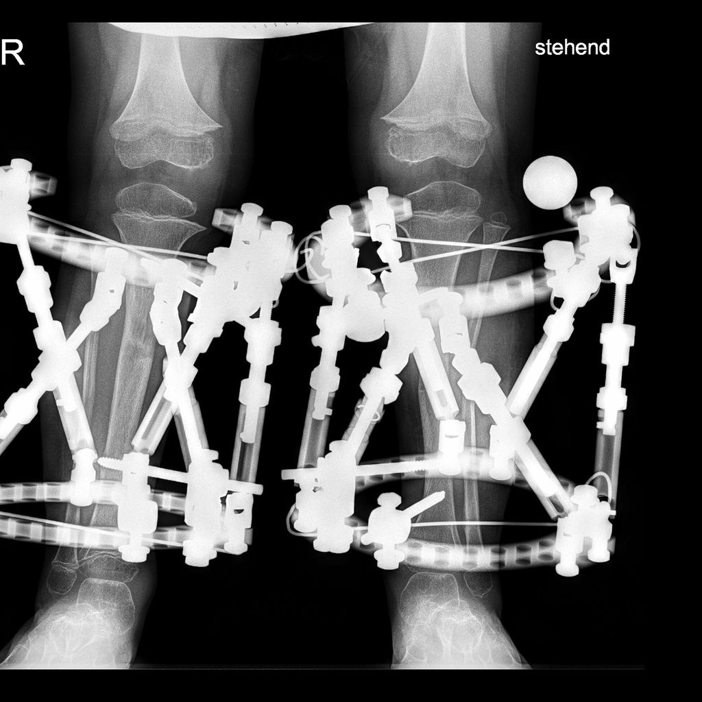 Achondroplasie: kinderorthopädische Betreuung im Wachstumsalter ...