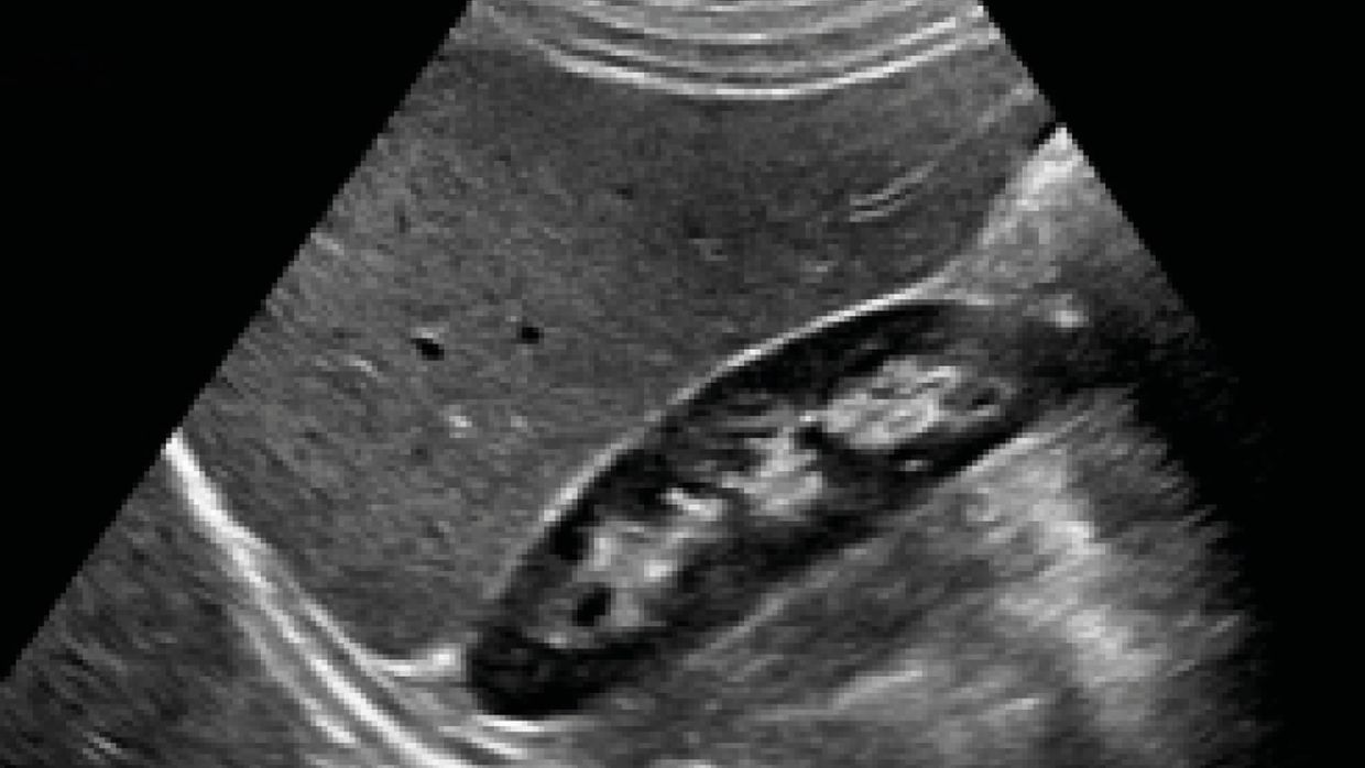 Fettleber im Fokus - Endokrinologie & Diabetologie - Universimed ...