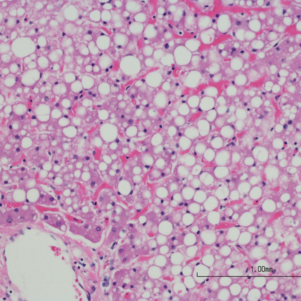 La stéatose hépatique non alcoolique: sous-diagnostiquée et sous-estim ...