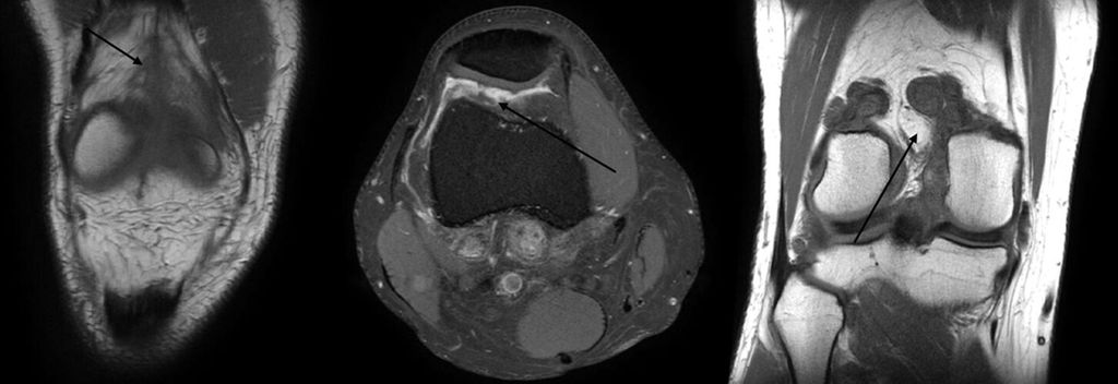 Pigmentierte villonoduläre Synovialitis: Ist eine präoperative Biopsie ...
