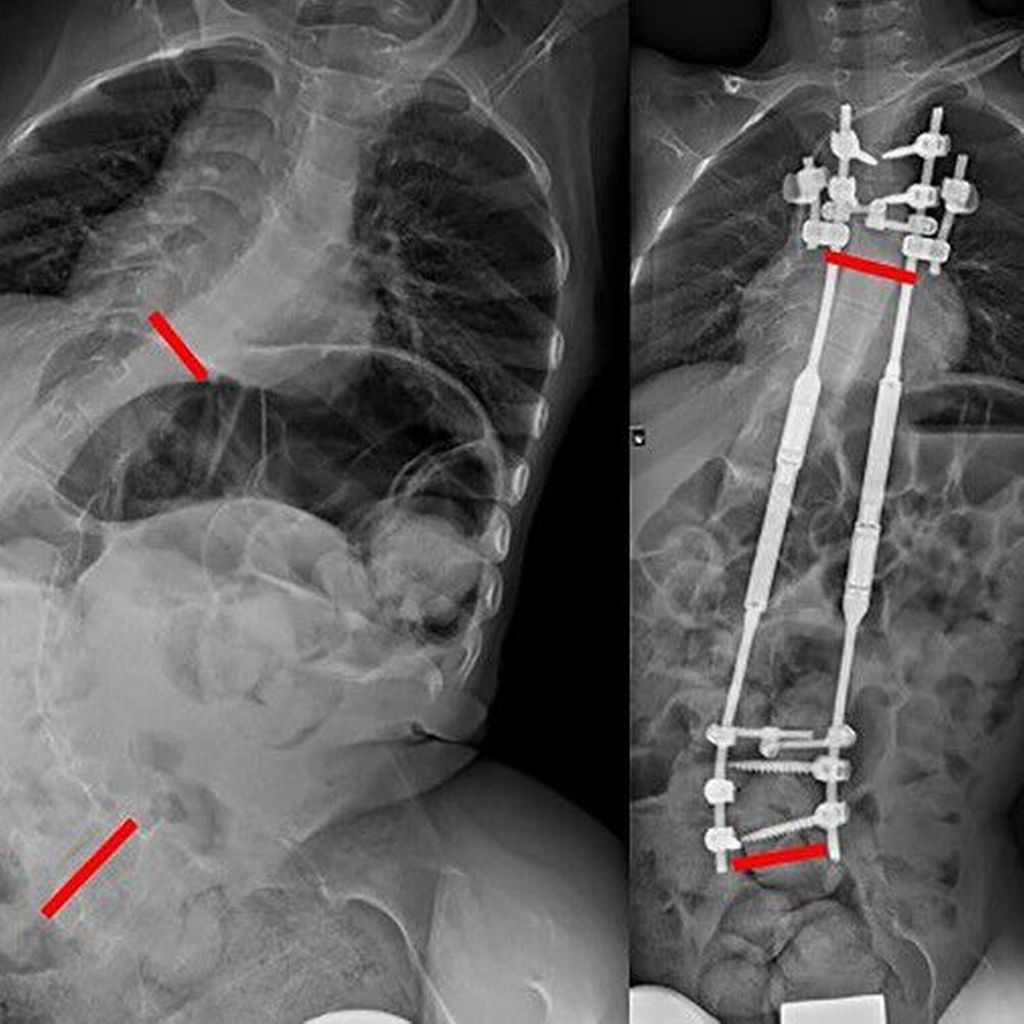Wachstumslenkende Verfahren in der operativen Versorgung kindlicher Sk ...