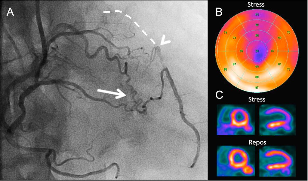 L’occlusion coronarienne chronique - Médecine interne - Universimed ...