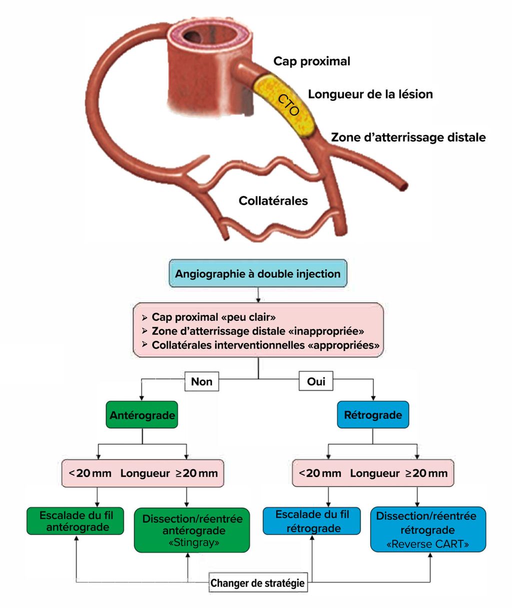 L’occlusion coronarienne chronique - Médecine interne - Universimed ...