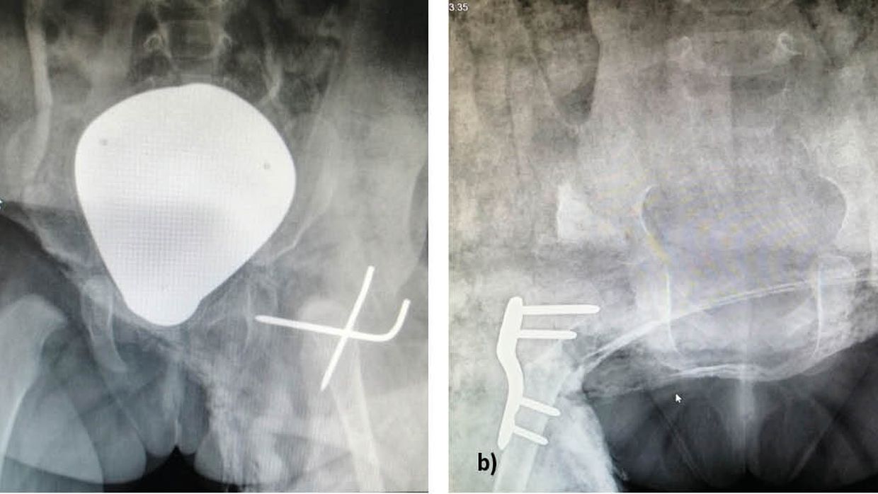 Offene Einrichtung bei Luxation der Säuglingshüfte - Orthopädie ...