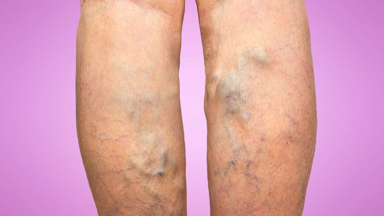 Thermische Ablation als Standard in der Behandlung der Stammvarizen ...