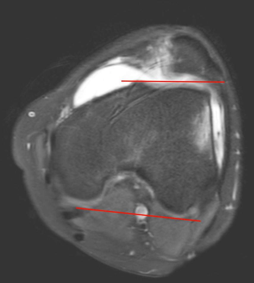Diagnostik und Planung knöcherner Eingriffe bei Patellainstabilität ...