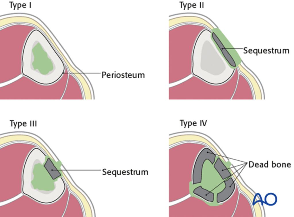 Long bone osteomyelitis in adults: current concepts in pathophysiology ...