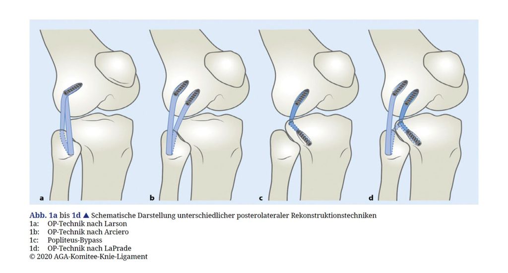 Posterolaterale Zusatzeingriffe - Orthopädie & Traumatologie ...