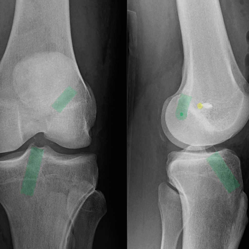 Akute VKB-Ruptur: ein evidenzbasierter Behandlungsalgorithmus ...