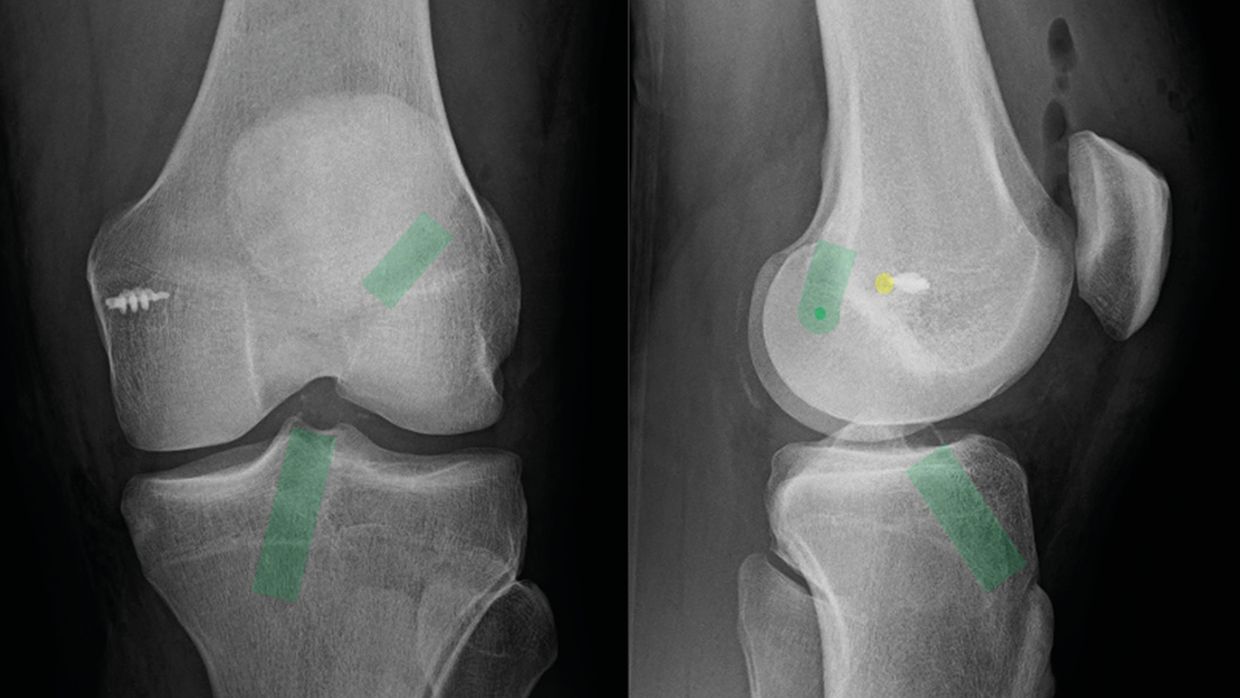 Akute VKB-Ruptur: ein evidenzbasierter Behandlungsalgorithmus ...