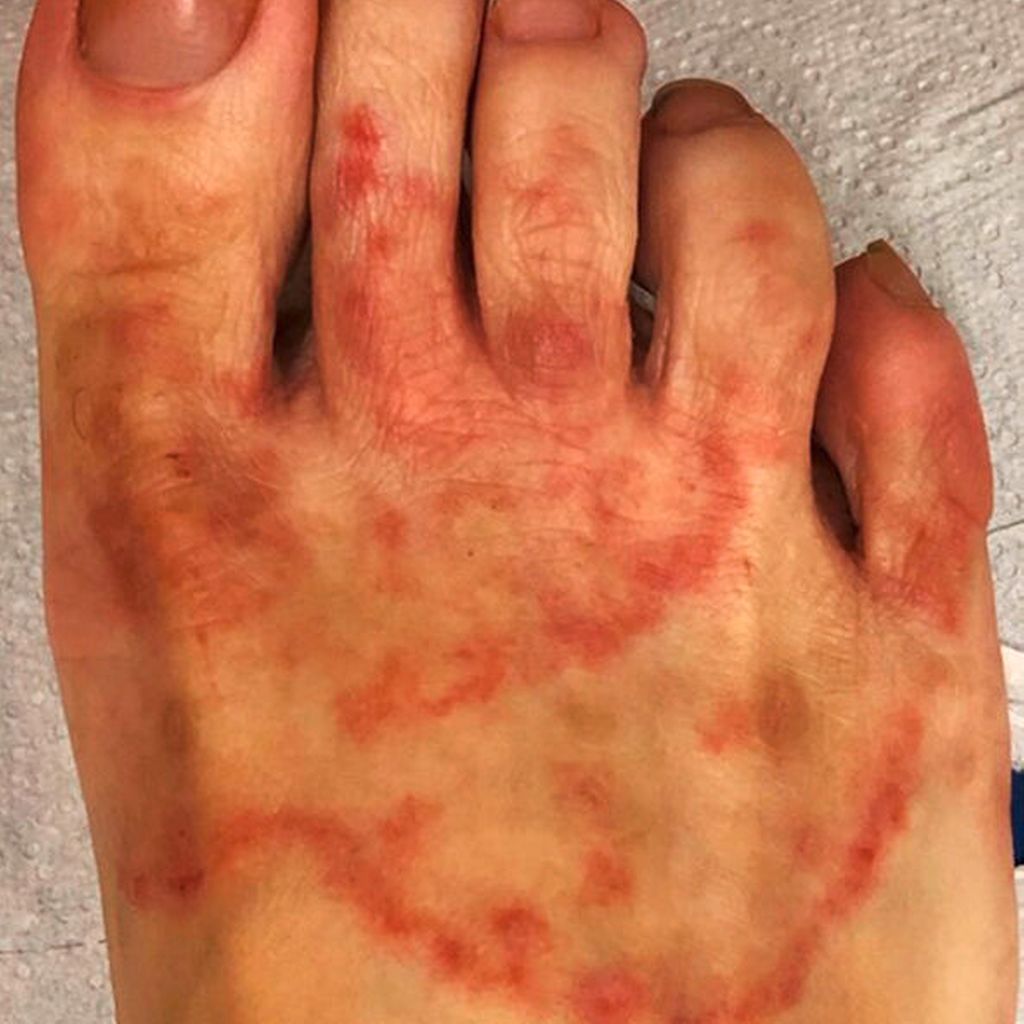 Dermatophytoses: aspects cliniques et traitement - Médecine interne ...