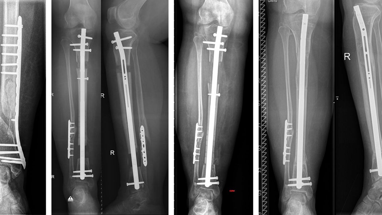 Das Precice®-Segmenttransport-System: eine Revolution in der rekonstru ...