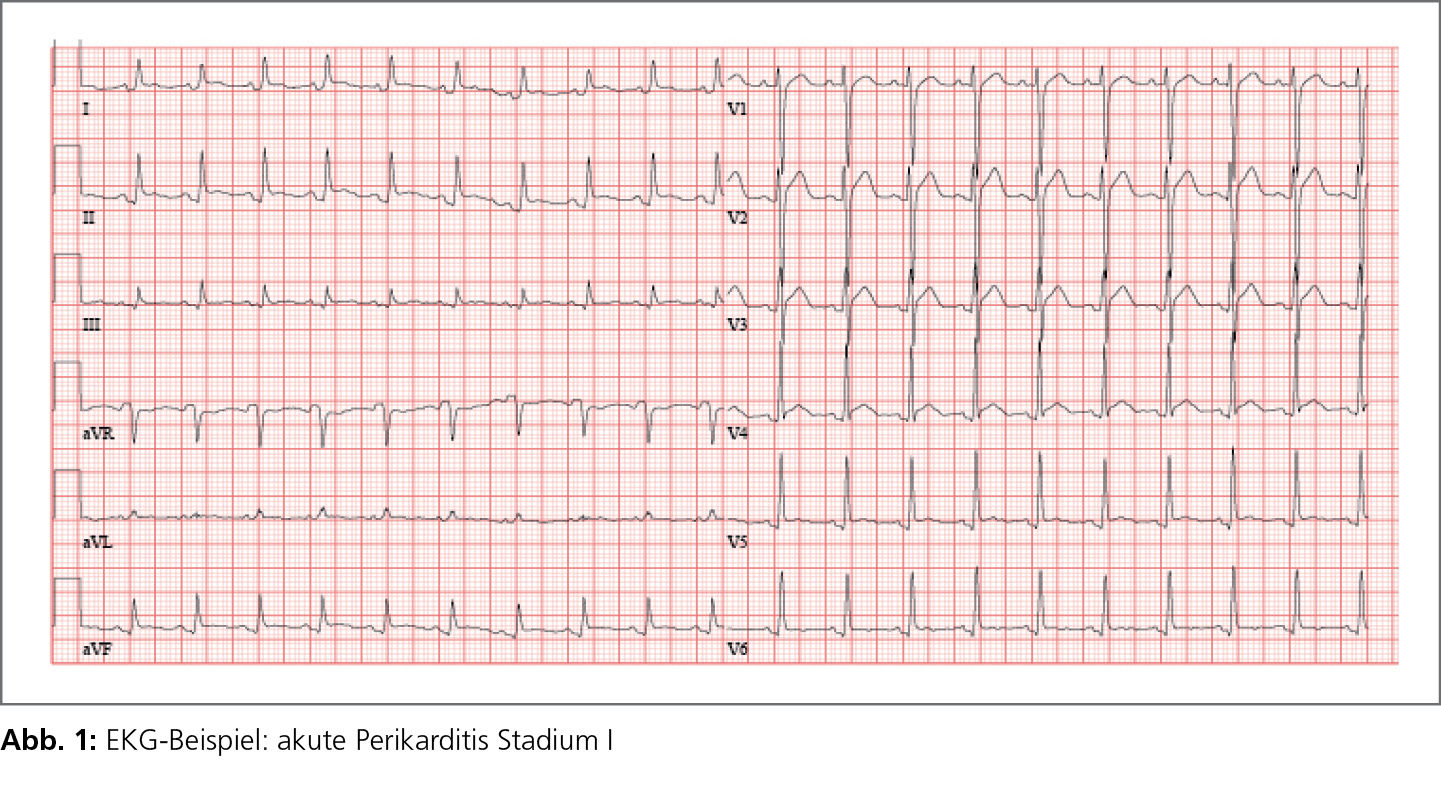 EKG-Perikarderguss