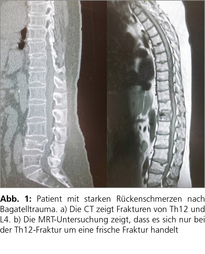 Osteoporotische Wirbelkörperfrakturen - Orthopädie & Traumatologie ...