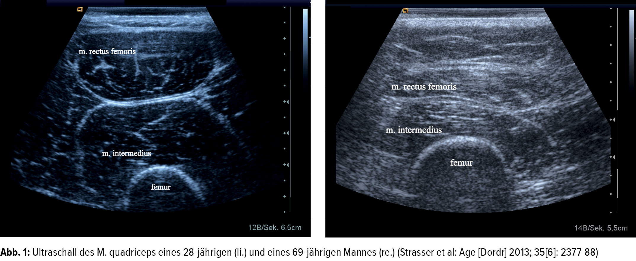 Physikalische Medizin bei Muskelschwund – ein Update - Orthopädie ...