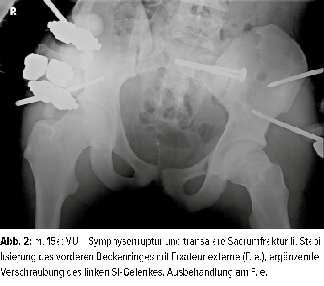 Becken- und Acetabulumfrakturen im Kindes- und Jugendalter - Orthopädie ...