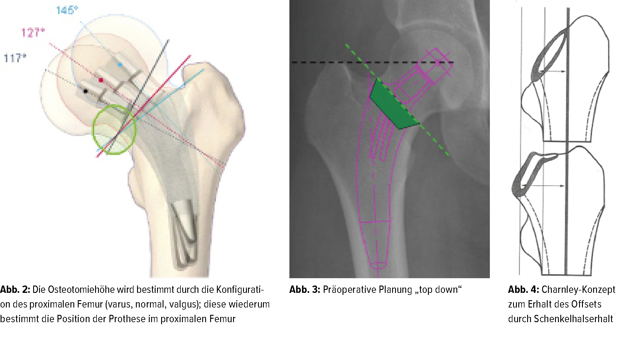 Klassifikation von Kurzschaftsystemen in der Hüftendoprothetik ...