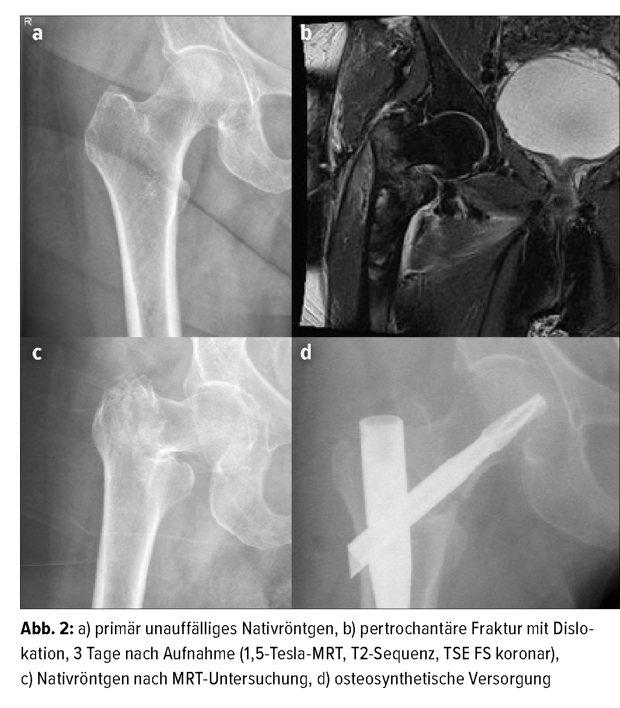 Stellenwert der mRt-Untersuchung bei pertrochantären Frakturen - Orthopädie & Traumatologie ...