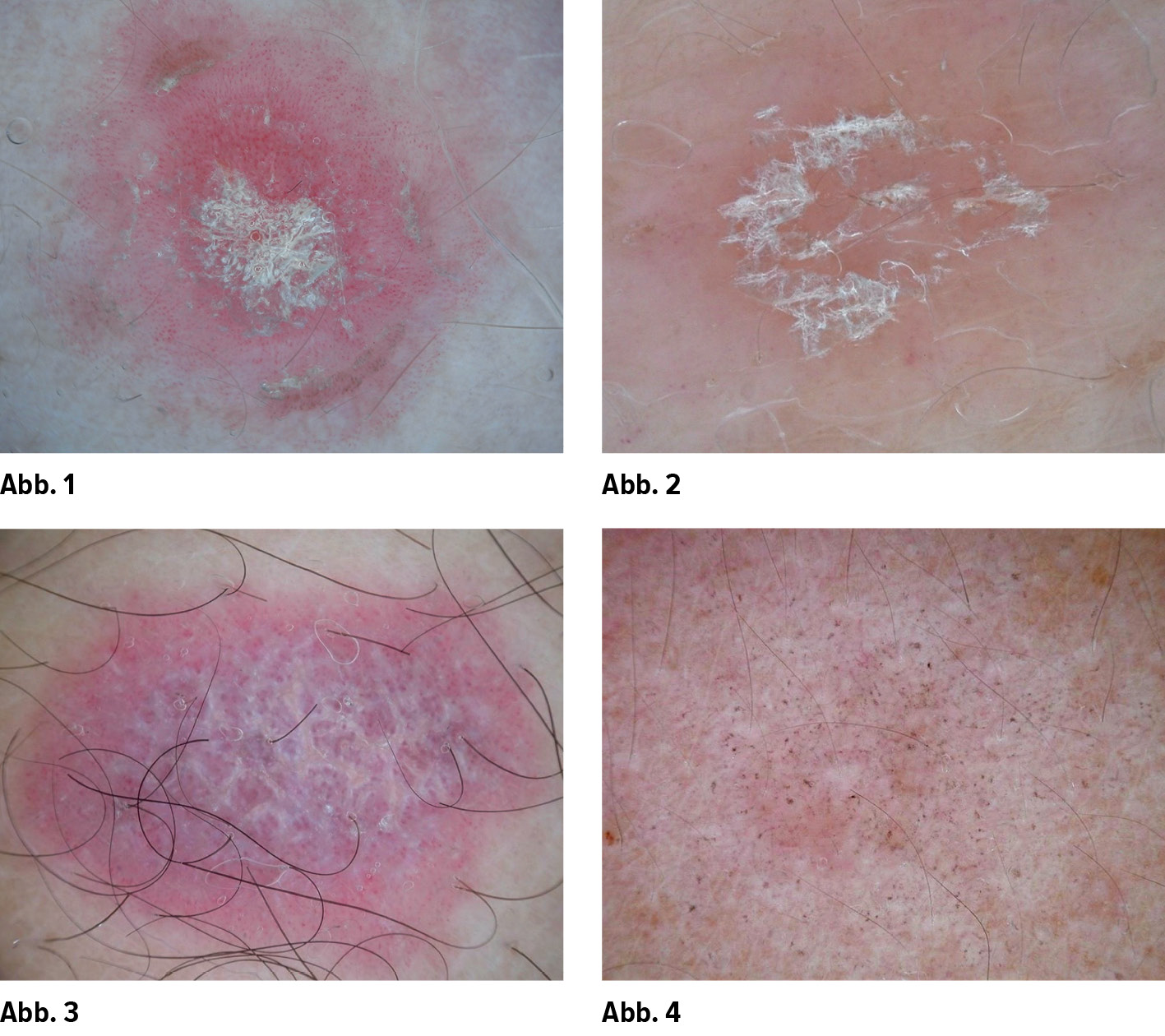 Entzündliche Dermatosen – klinischer Blick versus Dermatoskopie ...