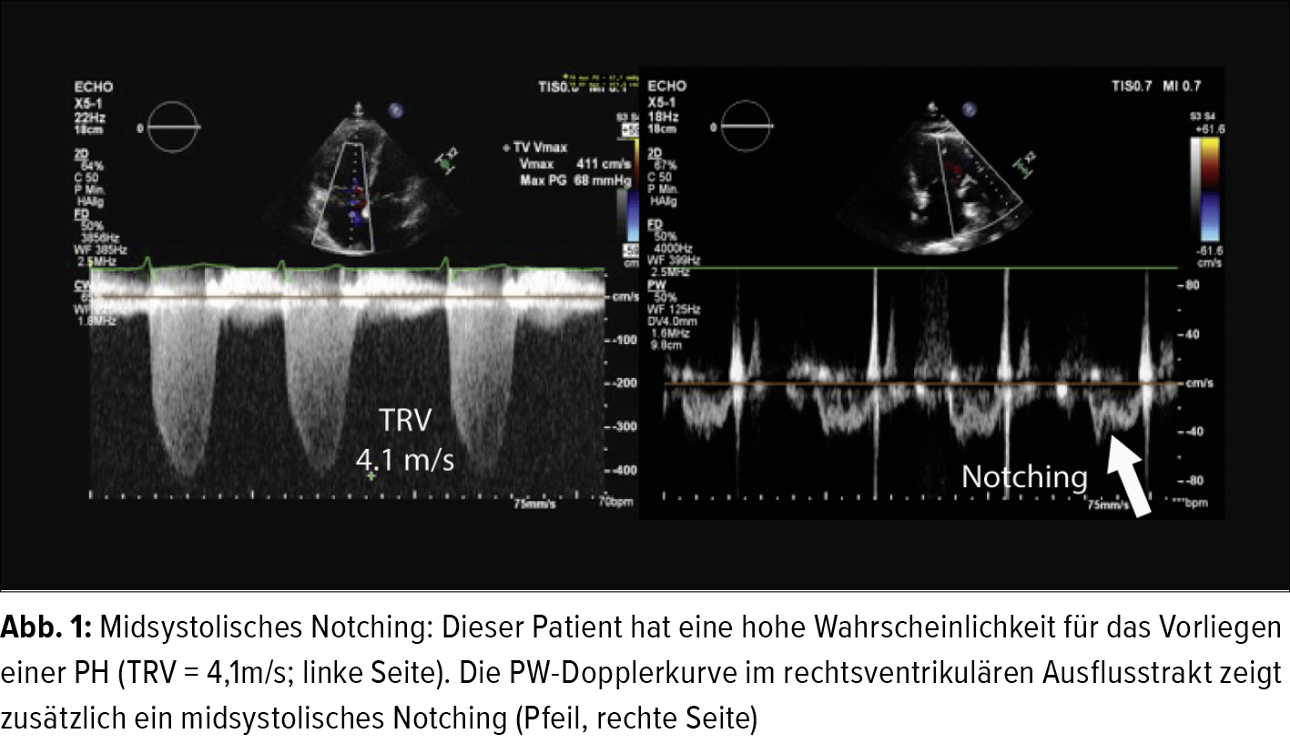 1x1 der Echokardiografie bei pulmonaler Hypertonie - Kardiologie ...