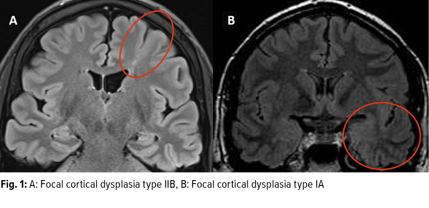 Malformations of cortical development and epilepsy - Neurologie ...