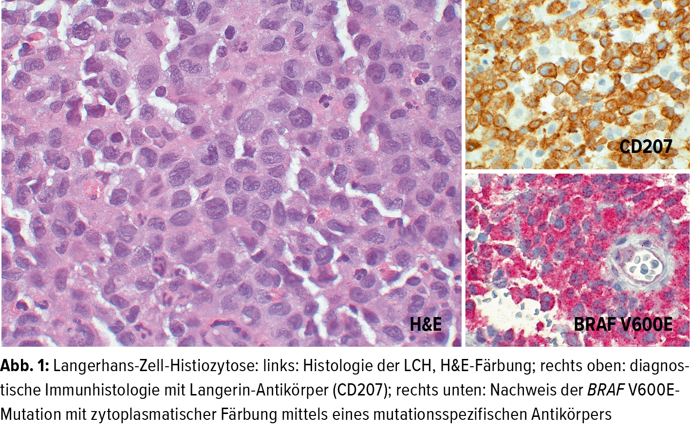 Histiocitose De Celulas De Langerhans Langerhans Zell Histiozytose
