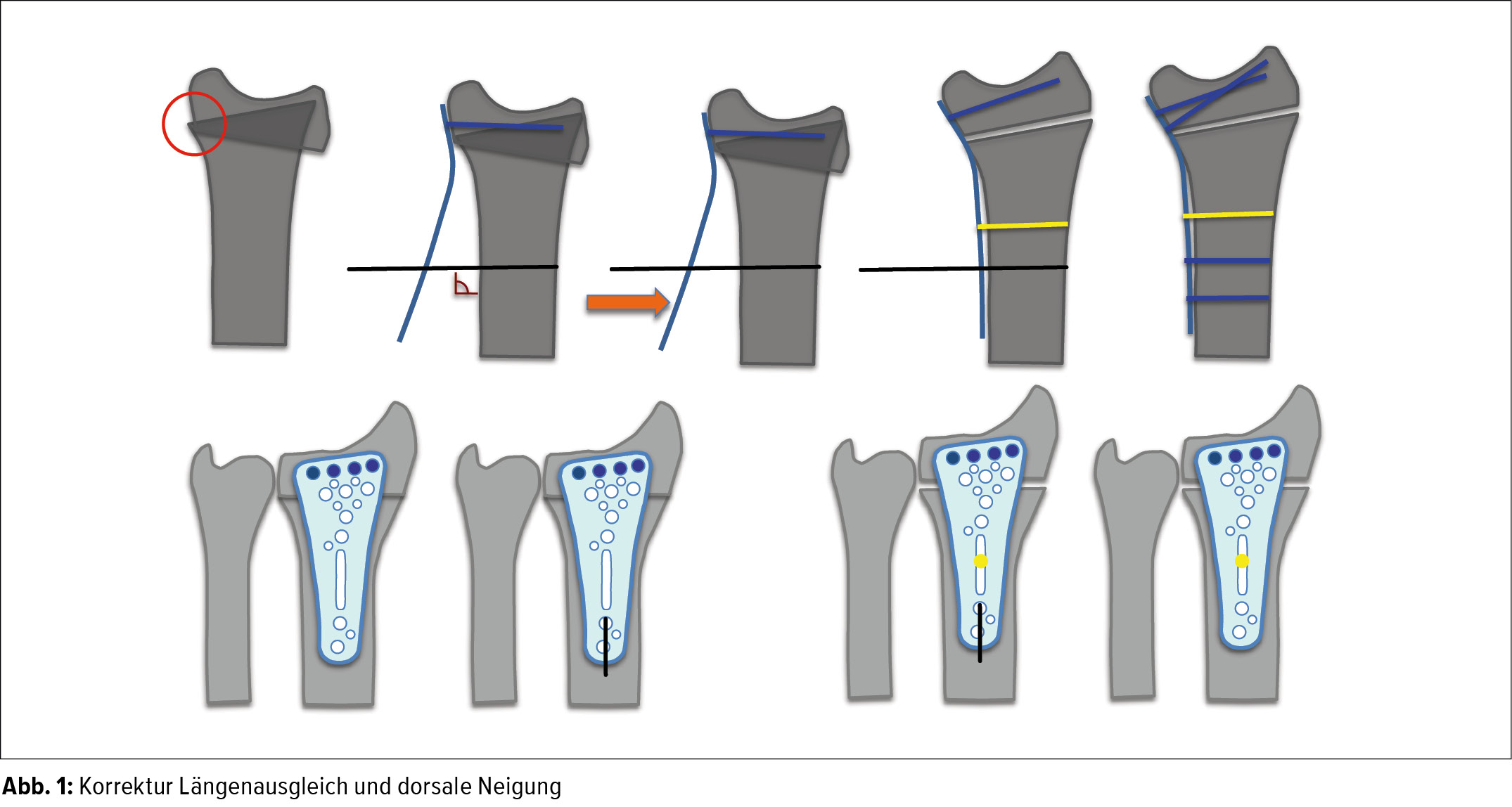 Palmare winkelstabile Verplattung – Tipps und Tricks zur Vermeidung von ...
